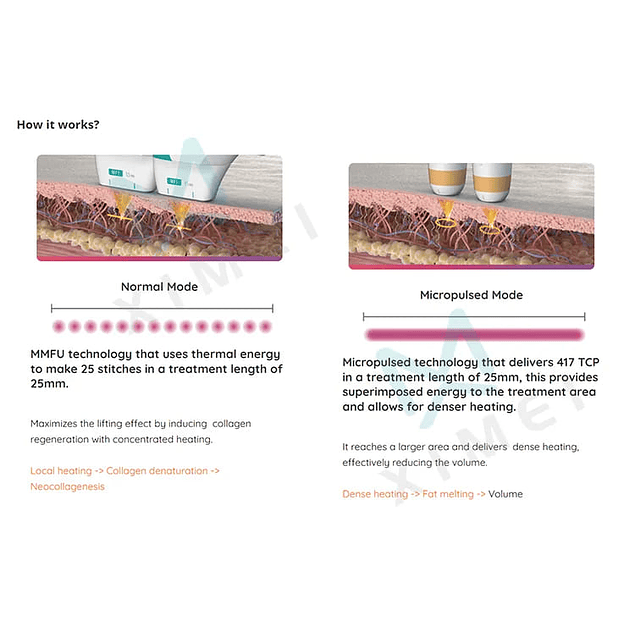 HIFU 12D MPT VERTICAL
