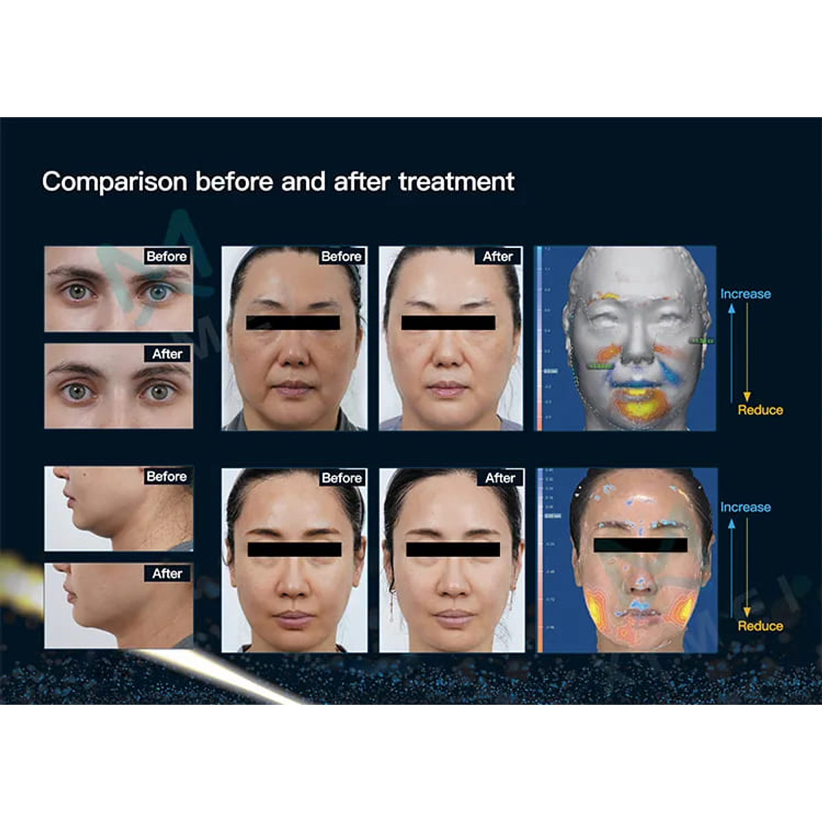 HIFU 12D MPT VERTICAL