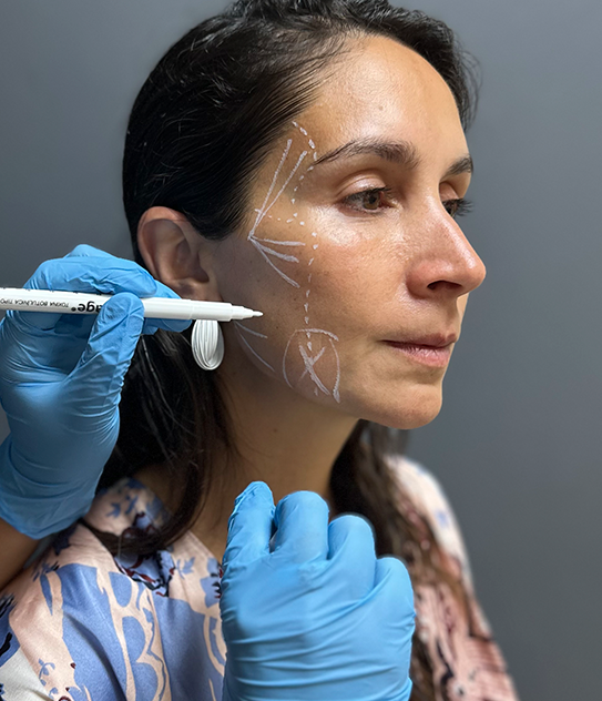 Pack Bioestimulación de Colágeno con Radiesse + Toxina Botul | Clínica ...