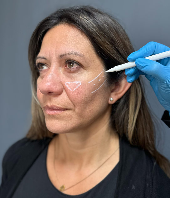 Relleno de pómulos con Ácido hialurónico | Clínica Estétika Médica