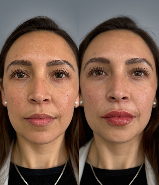 Botox® 3 zonas + Relleno de labios | Clínica Estétika Médica