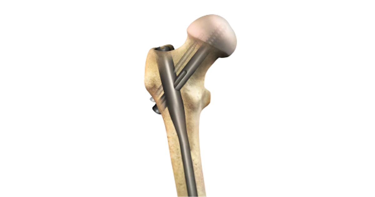 AFFIXUS Clavo Intramedular