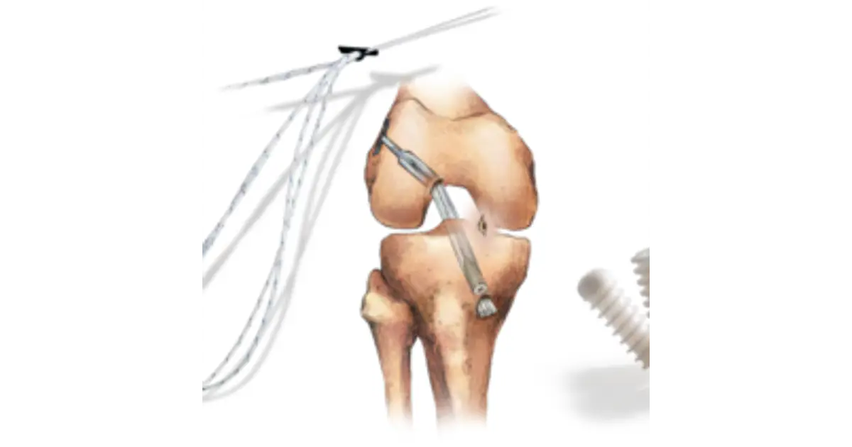 Toggleloc | Tornillo Composite