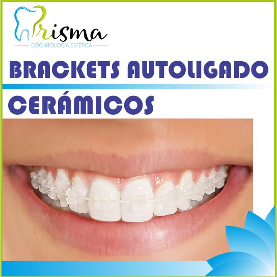 BRACKETS AUTOLIGADO CERÁMICOS CUOTA MENSUAL