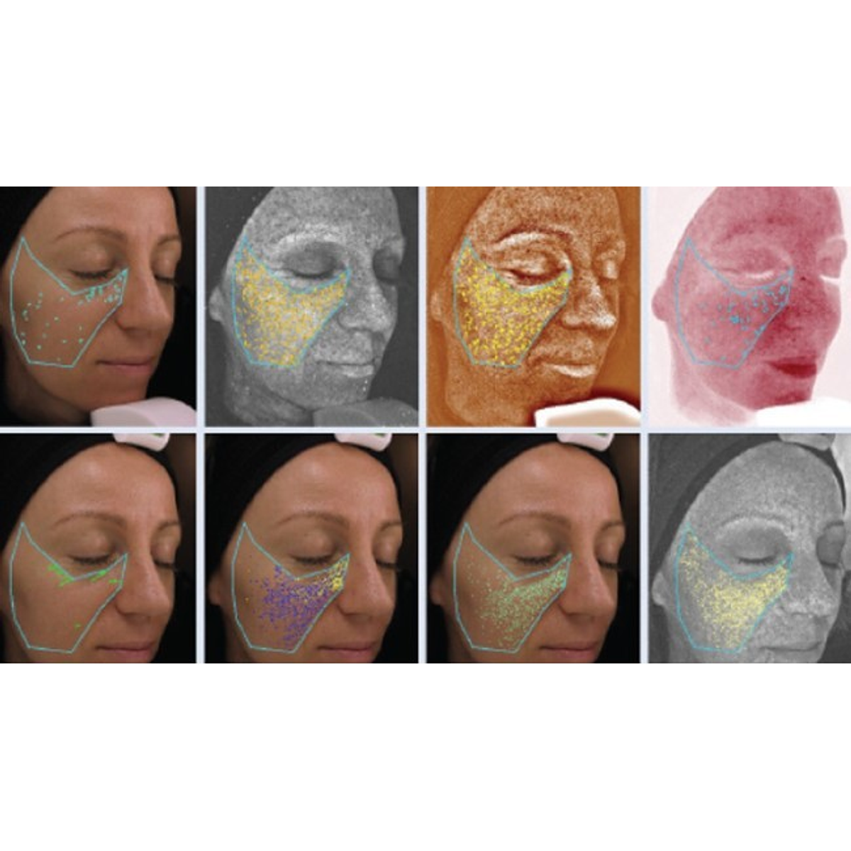 Análisis de piel con Visia Skin